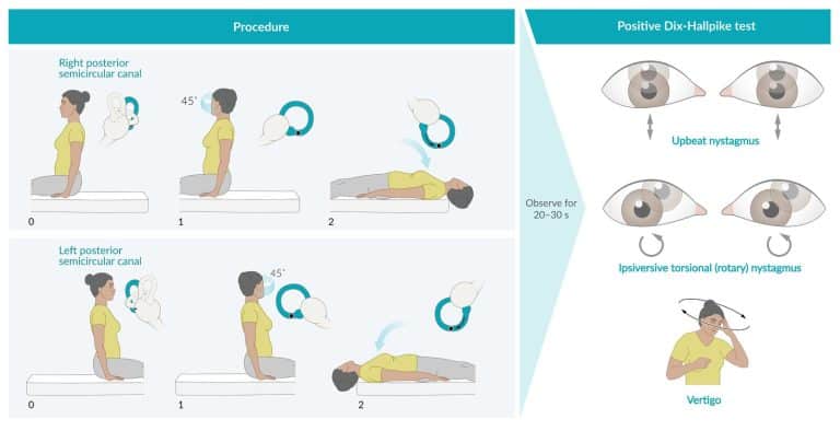 Chiropractic For Vertigo: Can It Really Help With Vertigo, And How To ...